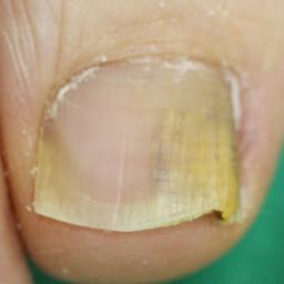 Onychomycosis segmentation v2 Instance Segmentation Dataset by Tim Lauer