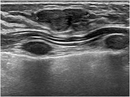 How to Use the Breast Cancer Prediction Instance Segmentation API