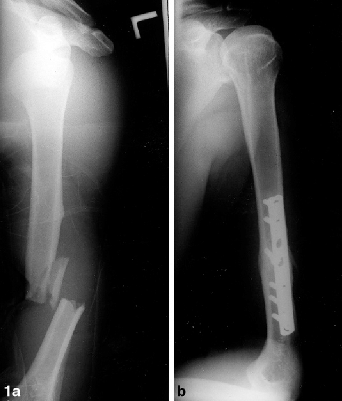 Fracture Detection in Xrays - Roboflow Universe