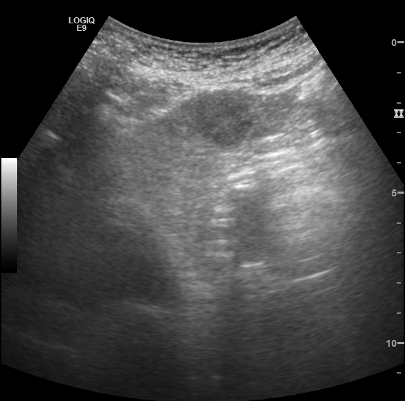 liver cancer Object Detection Model by Sungkyunkwan Univ