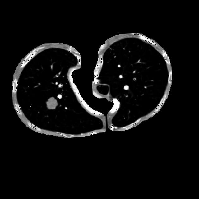 lung_nodule_detection using yolo v8 Object Detection Dataset and Pre-Trained Model by Eren