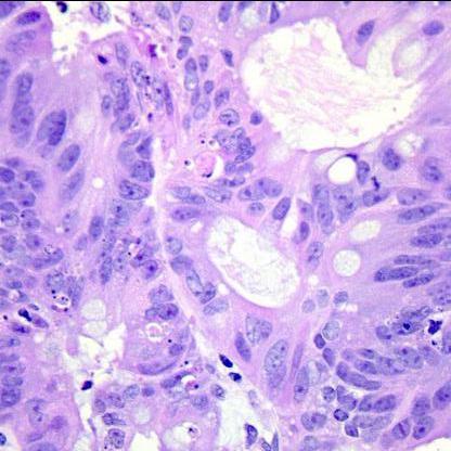 hera_colon Object Detection Model by hera