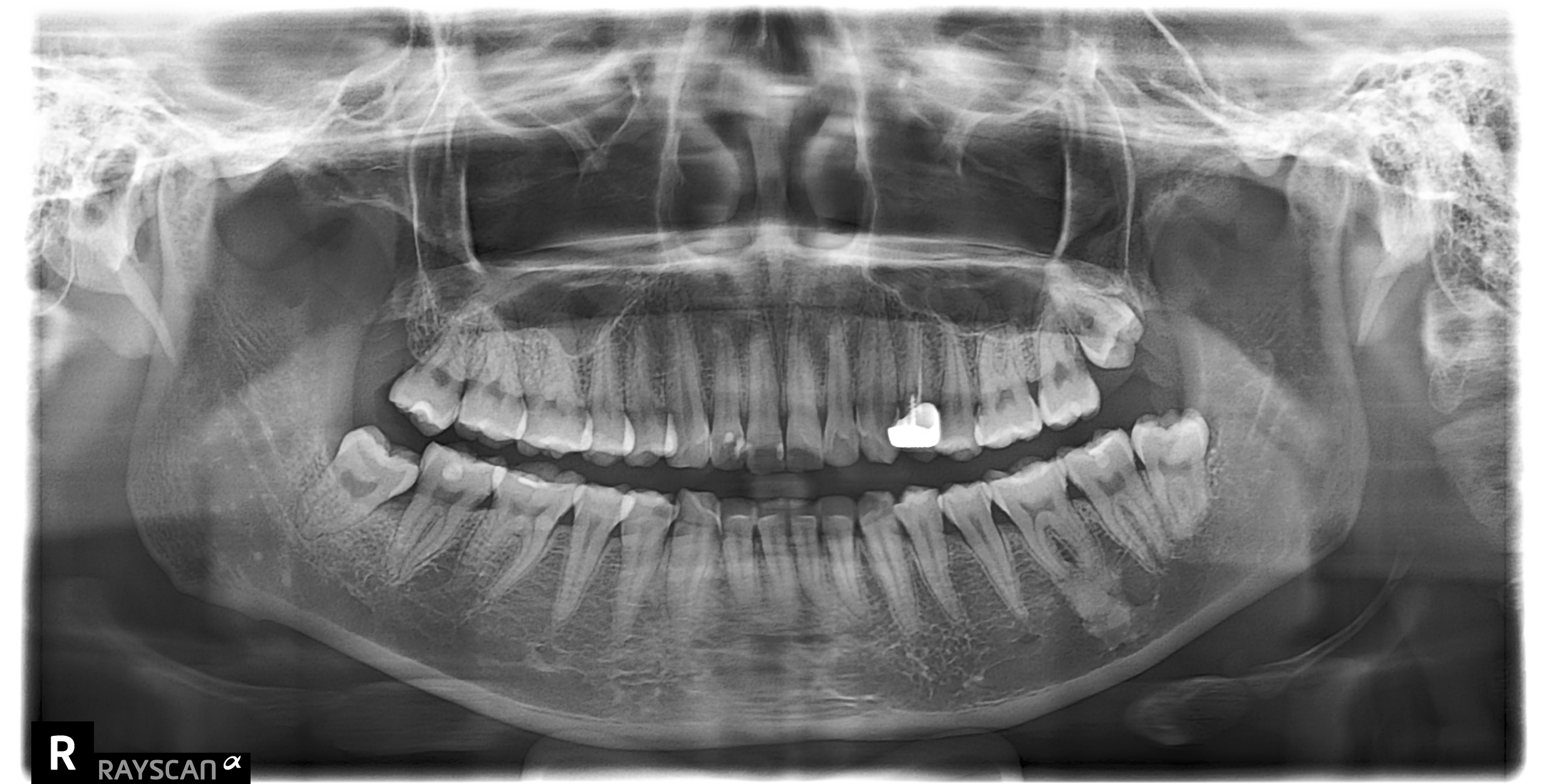 Diseases of tooth Object Detection Dataset by tooth