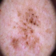 Skin Disease IA Detection Classification Model by Health AI Detection