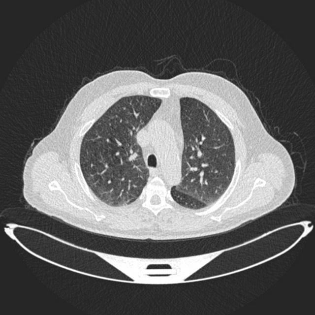 5A_LUNG_CANCER Object Detection Dataset and Pre-Trained Model by Reza