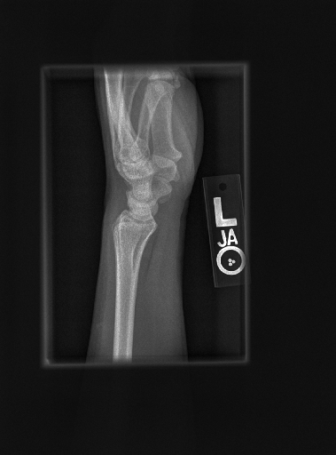 Bone Fracture Detection Dataset And Pre Trained Model By Miniproject