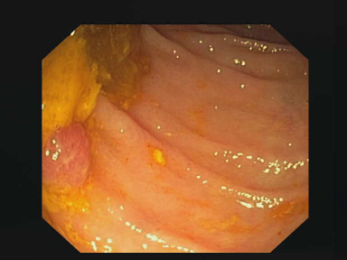 Polyp detection Object Detection Model by Colorectal Cancer Detection