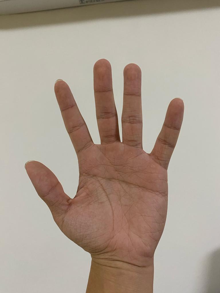 physiotherapy hand Object Detection Model by centadders