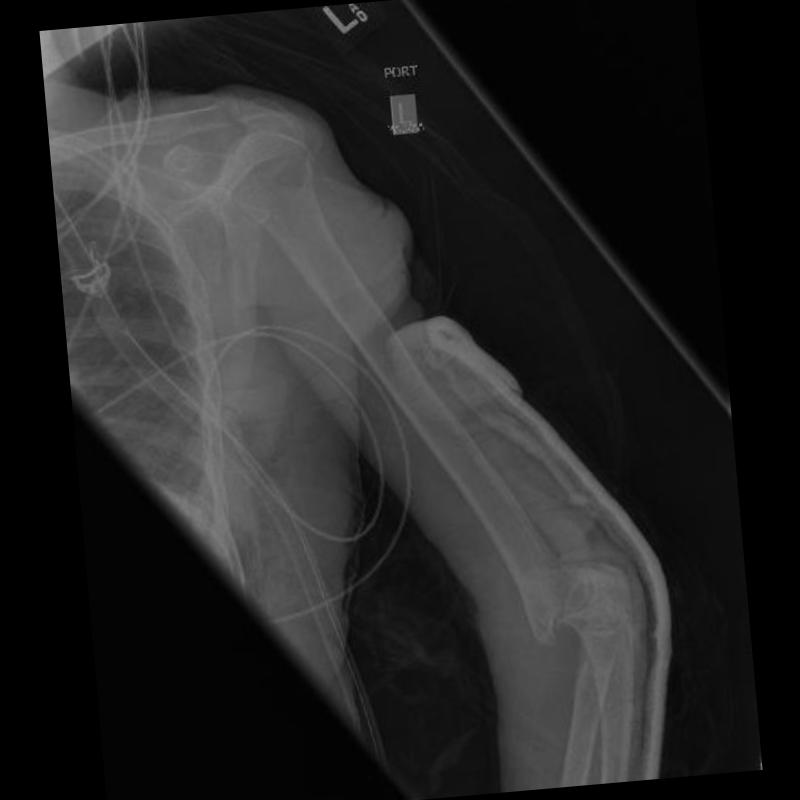 yolo_fracture_detection Object Detection Dataset by deeplearning