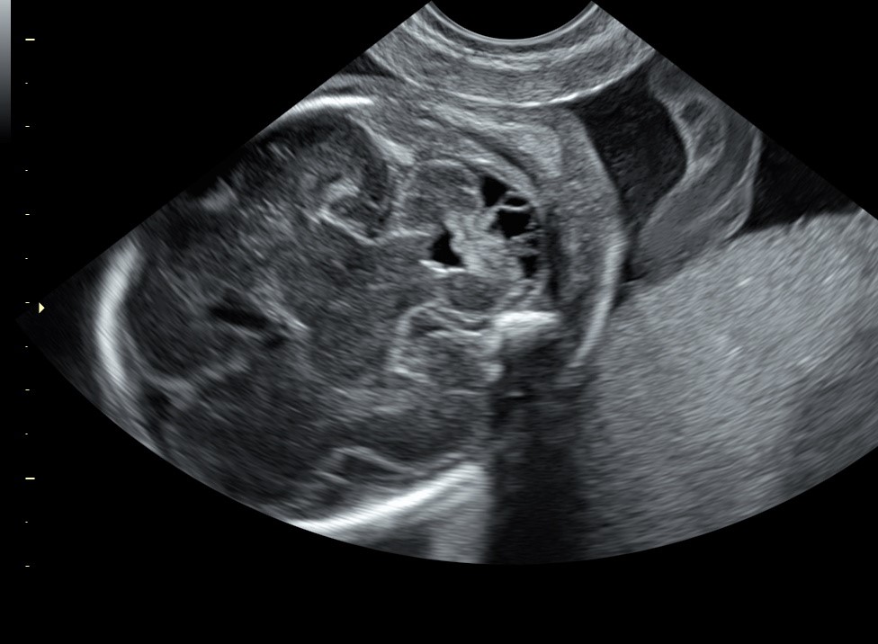 Fetal Brain Segmentation Instance Segmentation Dataset And Pre Trained