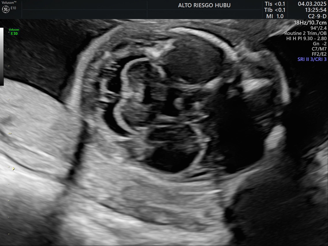 Fetal Brain Segmentation Instance Segmentation Dataset By Eirarodriguez