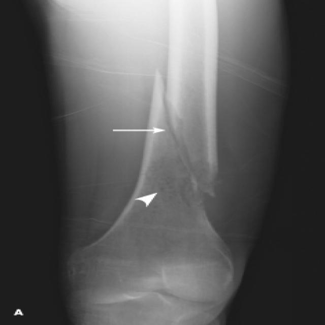 bone_detection Object Detection Model by Thanakon