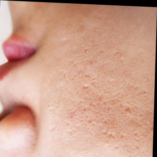 Acne Test Classification Dataset by IRDE