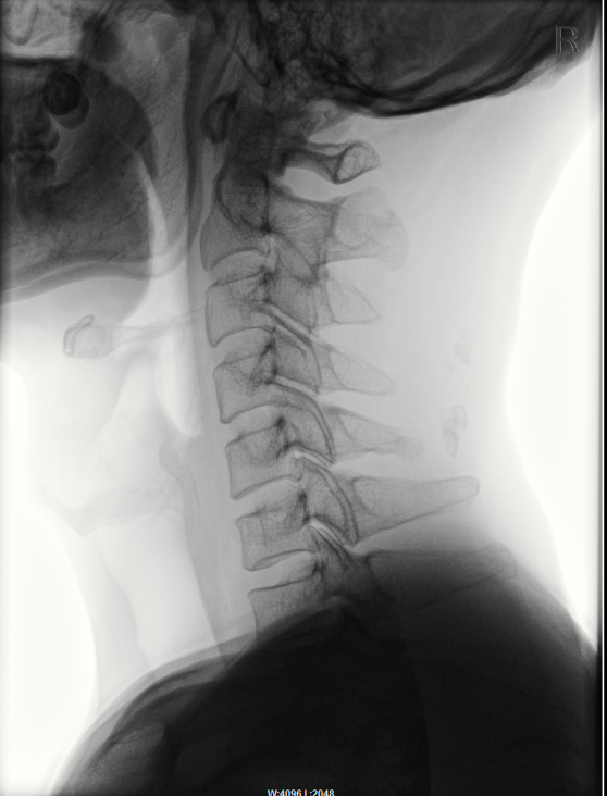 Annotate Vertebrae Instance Segmentation Dataset by PathLab