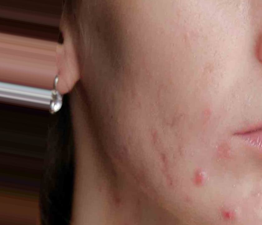 Acne Object Detection Dataset by 123