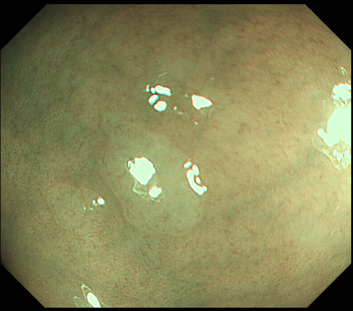 Polyp-NBI Instance Segmentation Dataset by Roller shutter for test