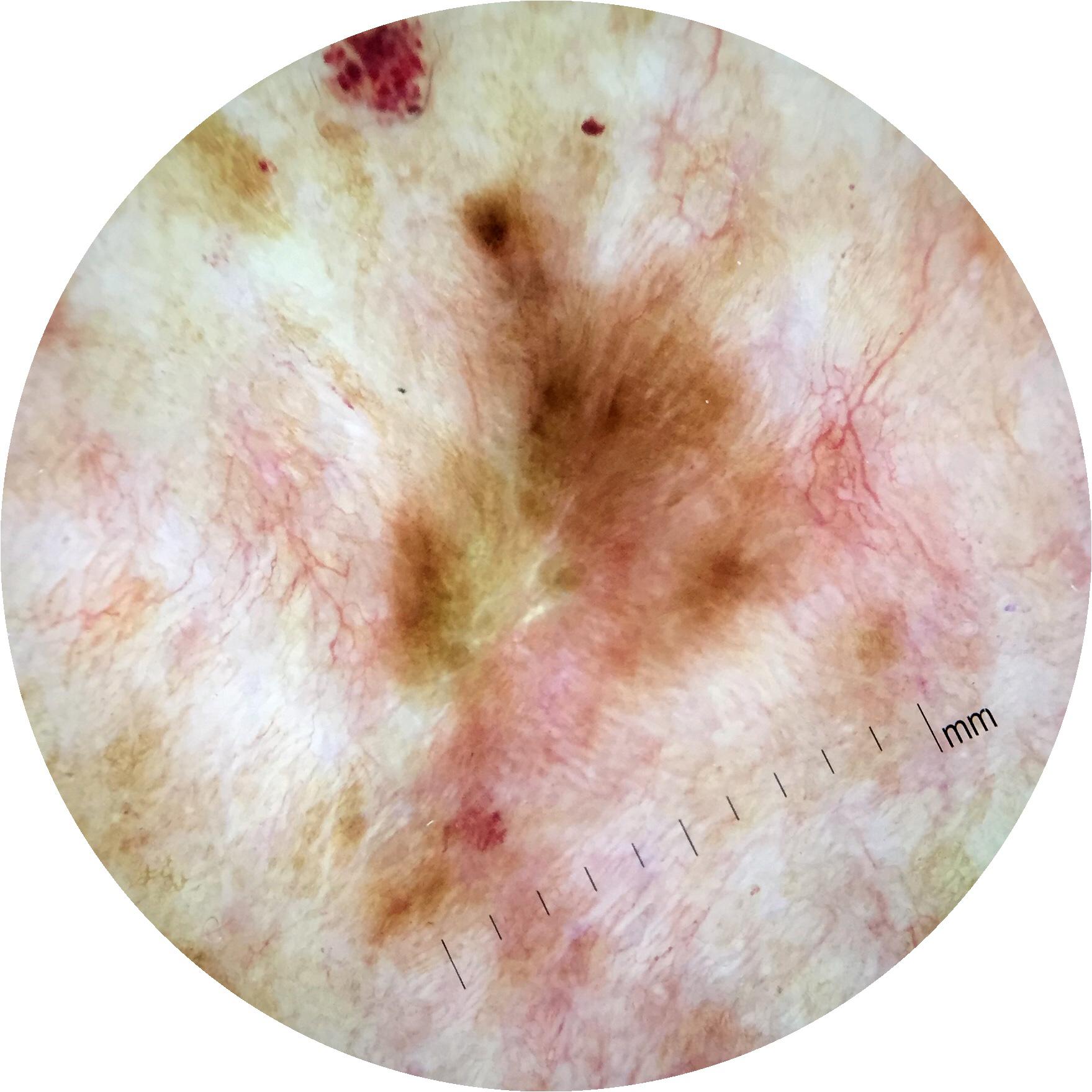 Melanoma Detection2023 Object Detection Dataset V1 2023 03 17 9 32pm