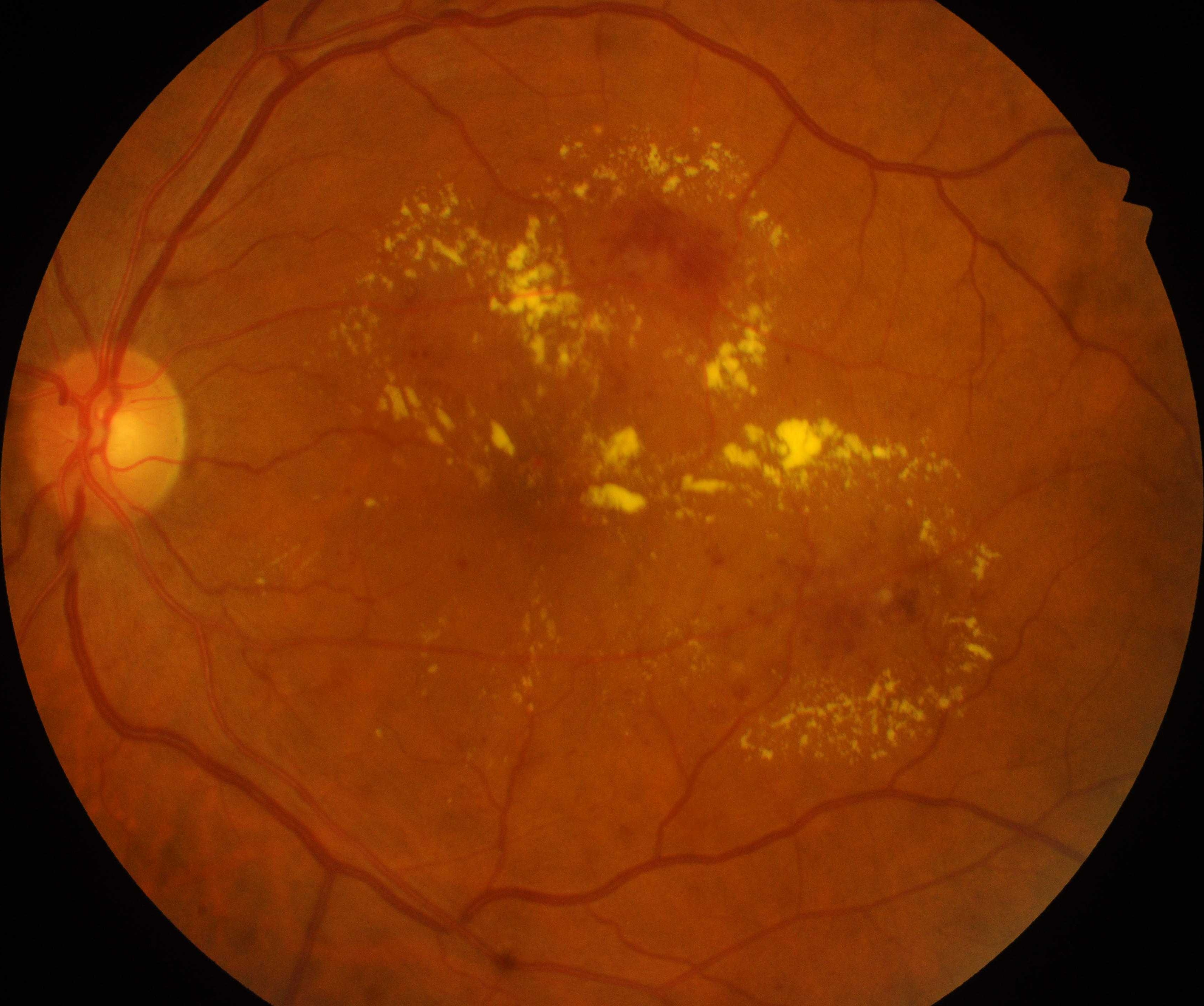 Idrid Detection Object Detection Dataset By Proyecto Retina