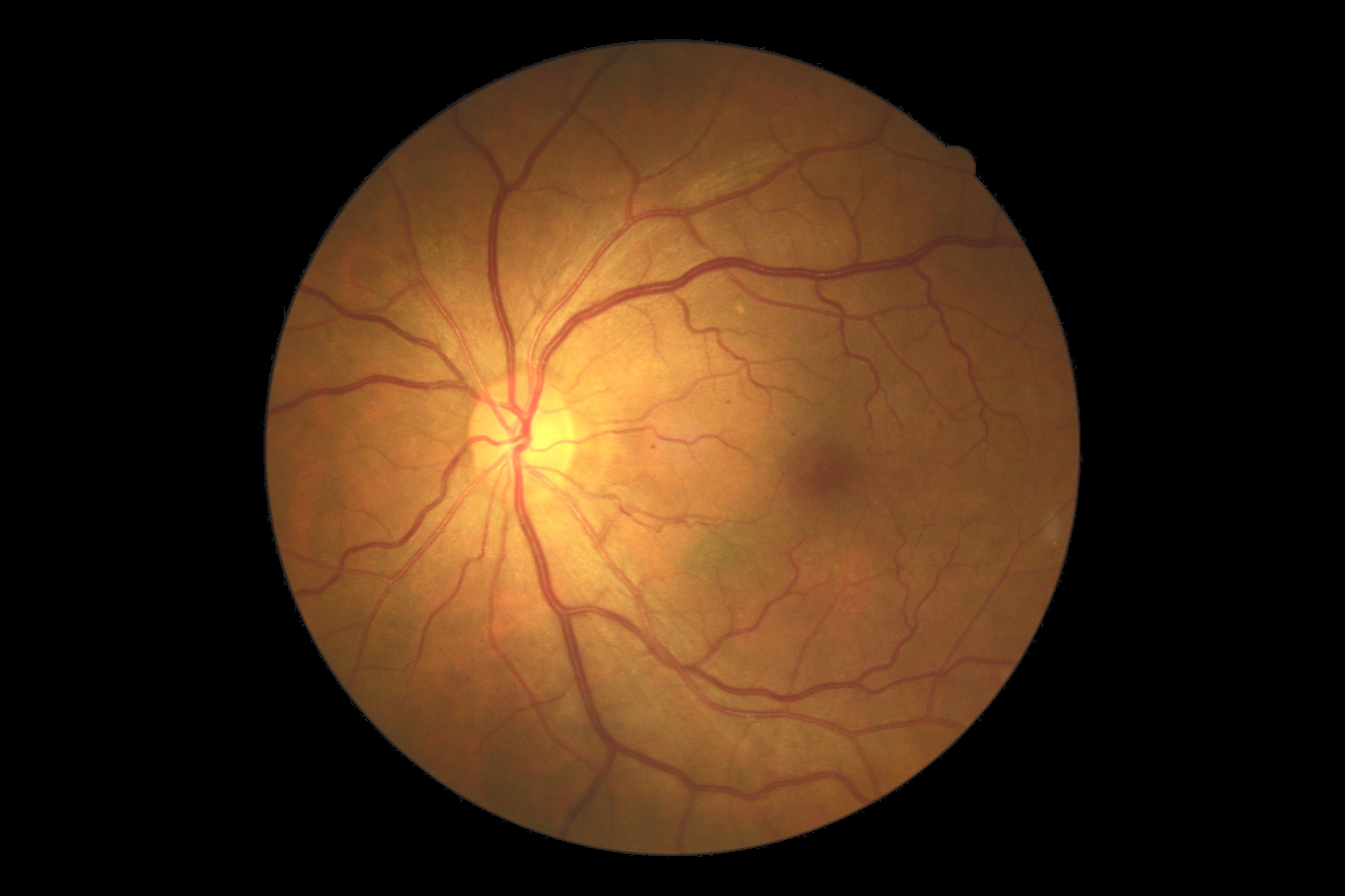 Retina Anomalies Detection Object Detection Dataset By Proyecto Retina