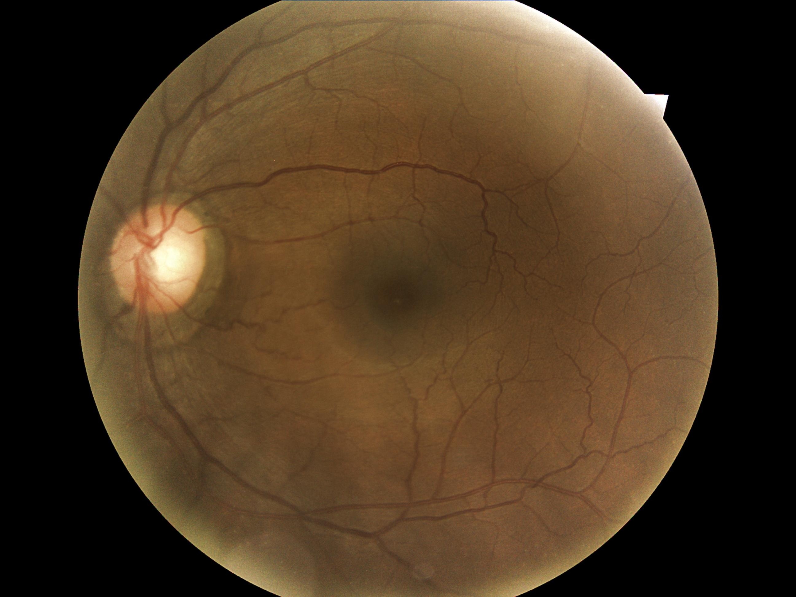 Etiquetado De Los Discos Ópticos Object Detection Dataset By Proyecto De Titulacin