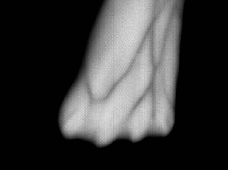 IVue vein detection Object Detection Dataset and Pre-Trained Model by ivue