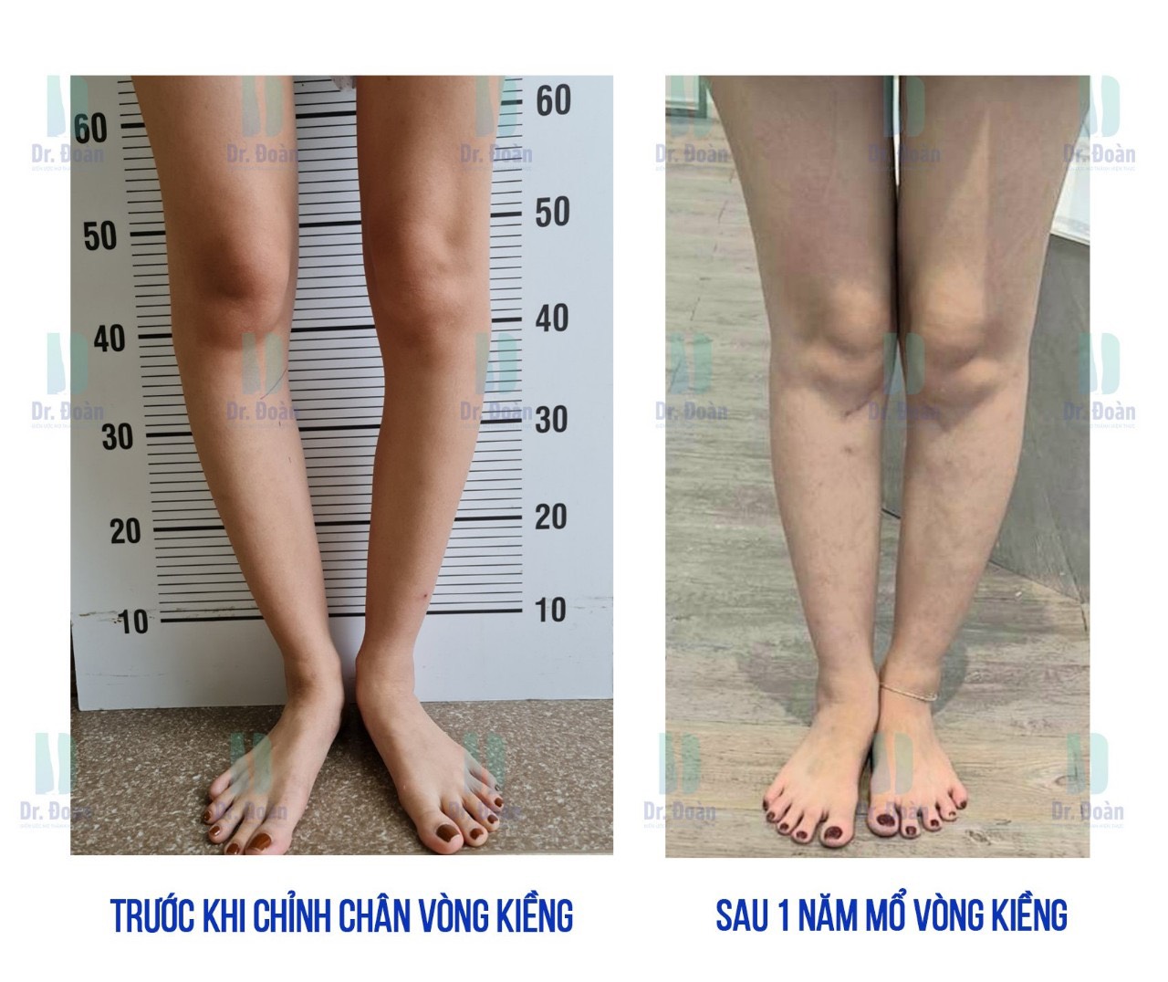 KneeAndAnkleDetection Object Detection Dataset by TinyML