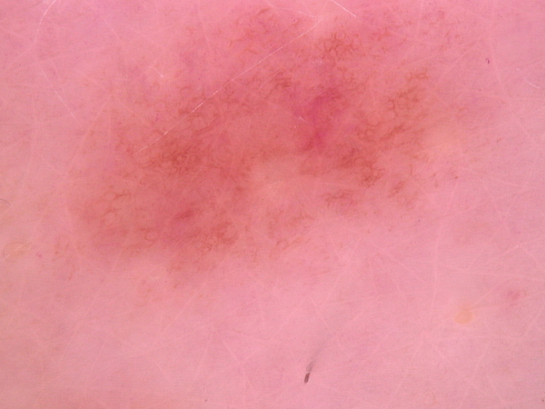 skin Object Detection Model by skin cancer