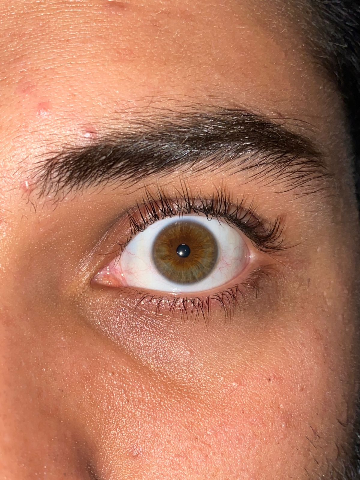 Catract-Eye Lump Detection Instance Segmentation Dataset by CatractEye Lump Detection