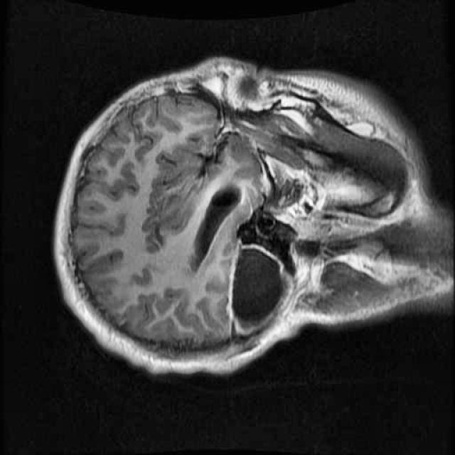 Brain Tumor Detection Object Detection Dataset And Pre Trained Model By