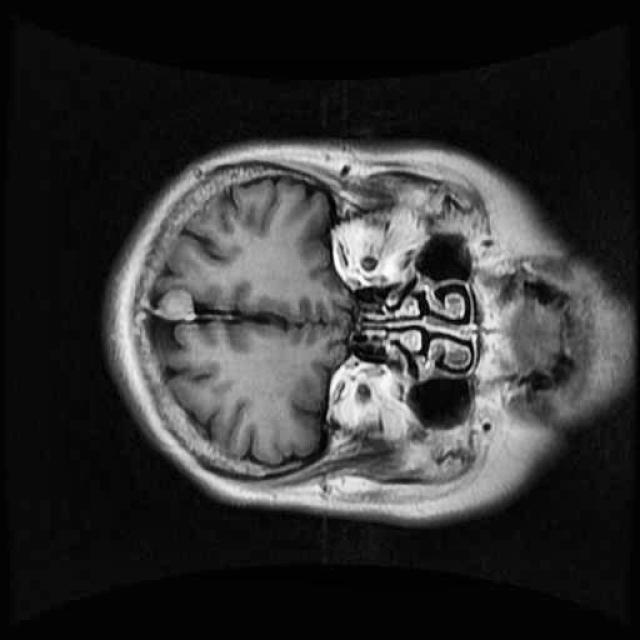 Brain Tumor Detection Object Detection Dataset By Nuzhaysh