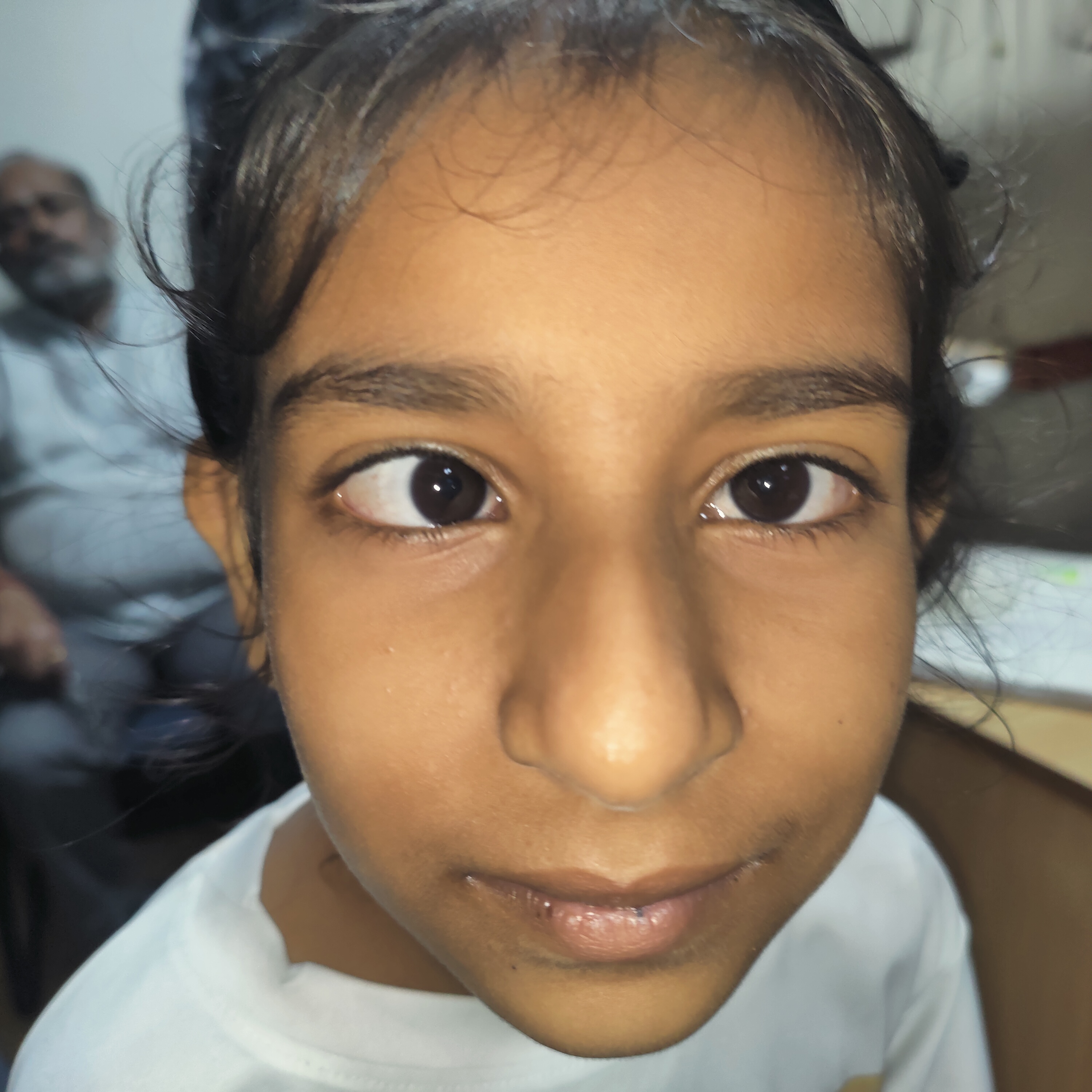 STRABIUSMUS_2_Classes Object Detection Model by Strabismus