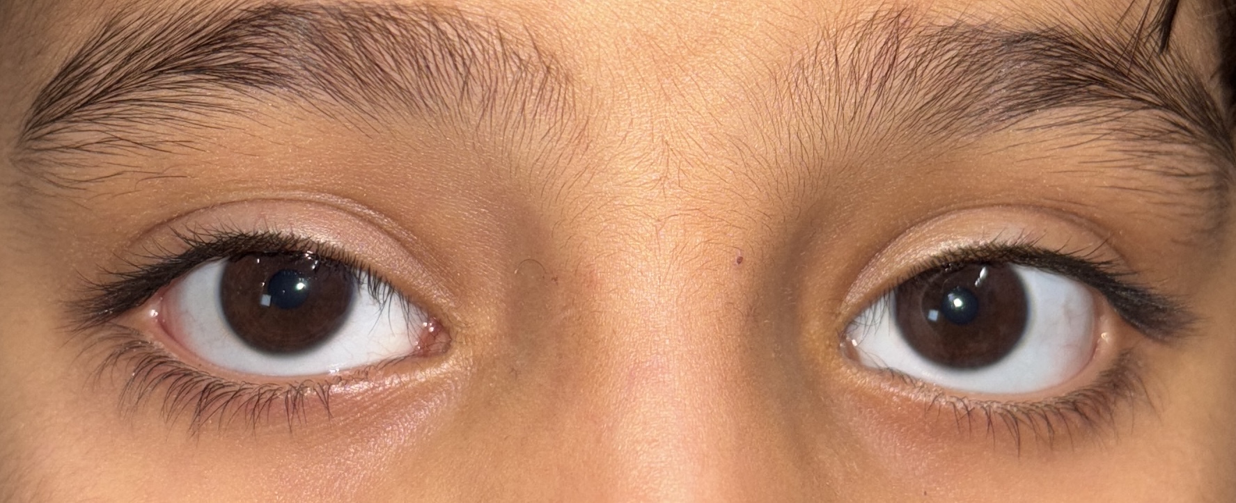 5 classes Object Detection Model by Strabismus