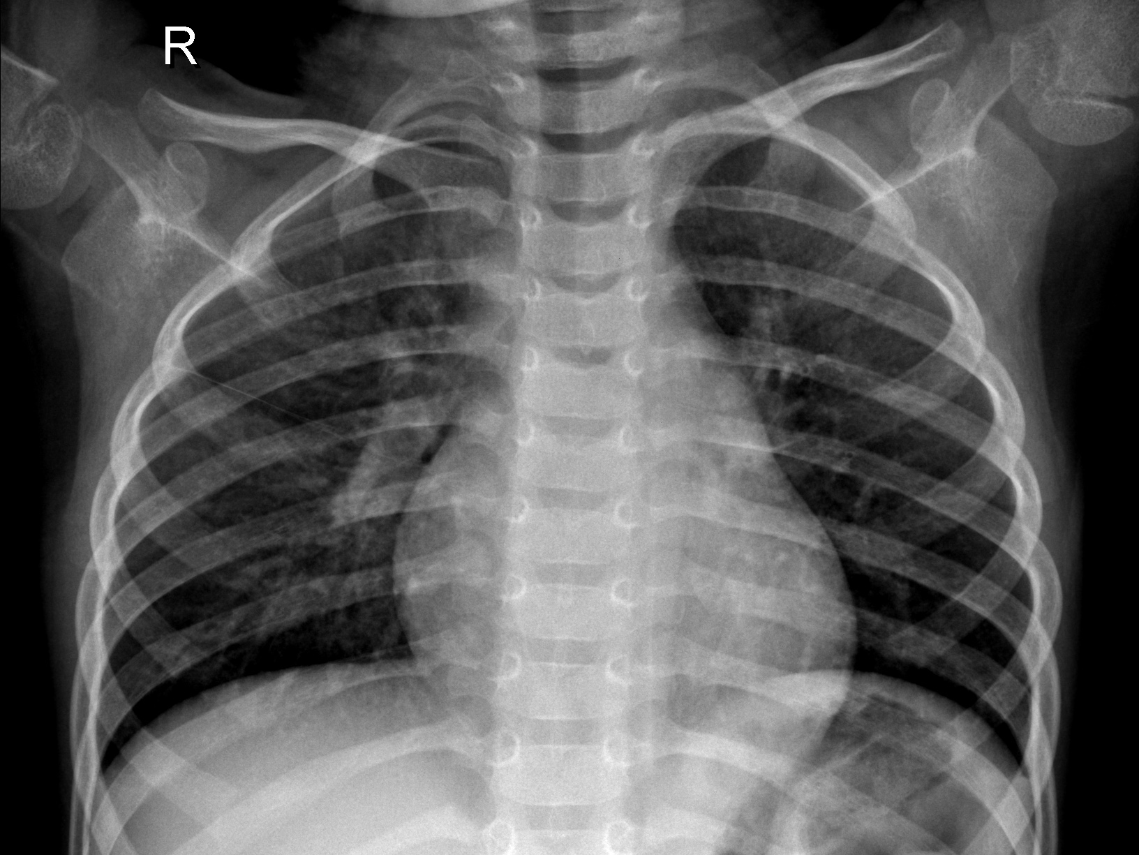 Chest X-Rays Classification Model by Mohamed Traore