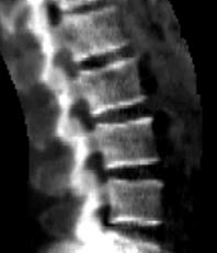 Spine Object Detection Dataset by Burapha