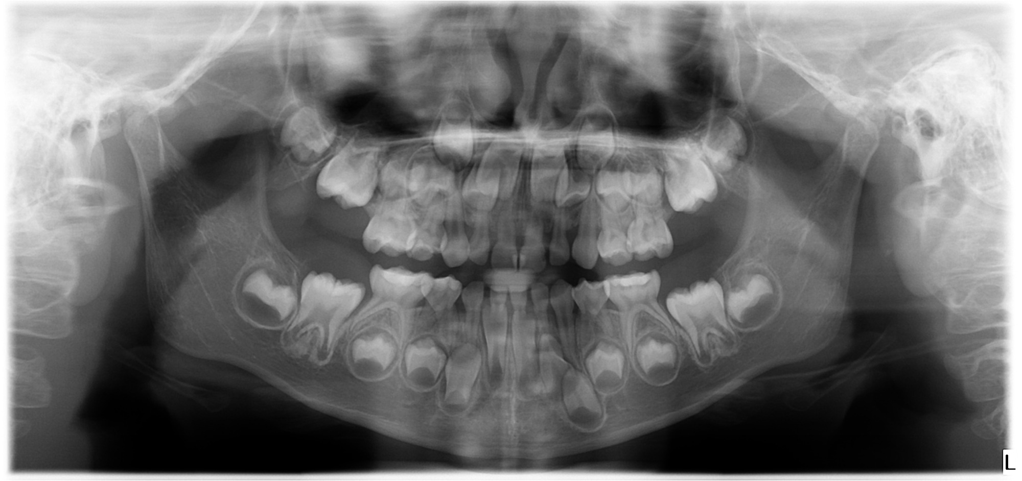 Dental_Diseases Object Detection Dataset by HIT