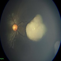 retina_detect Object Detection Dataset by Detect Cells