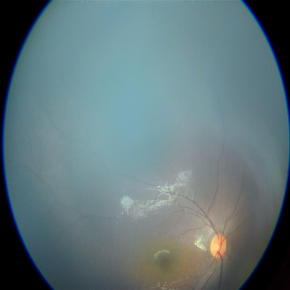 retina_detect Object Detection Dataset by Detect Cells