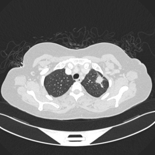 Classification Of Lung Cancer Classification Model By Capstone Project