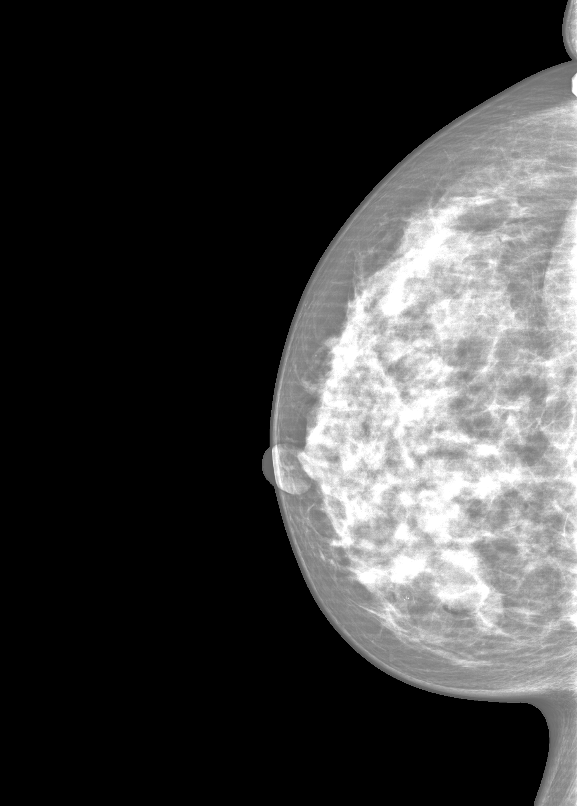 Breast Lesion Detection Object Detection Dataset And Pre Trained Model By Leonardo Iheme Leo