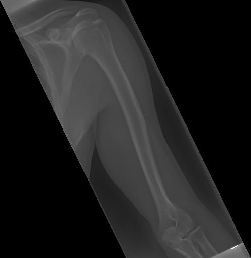 Bone Fracture Prediction Model Object Detection Dataset And Pre Trained