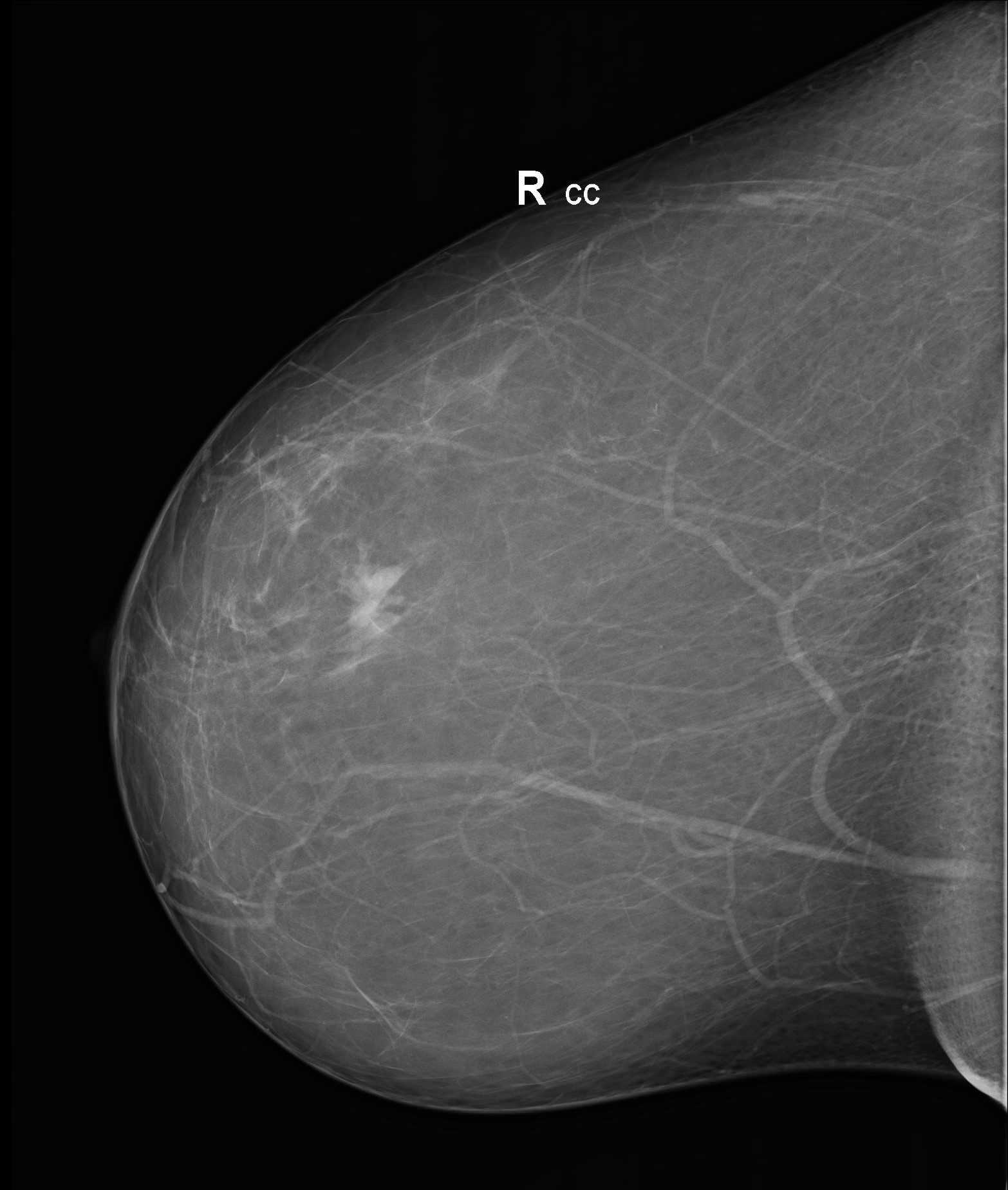 cancer 2 Object Detection Model by project-rvruw