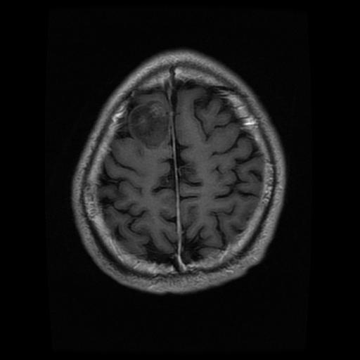 kaggle brain tumor Object Detection Dataset by brain tumor