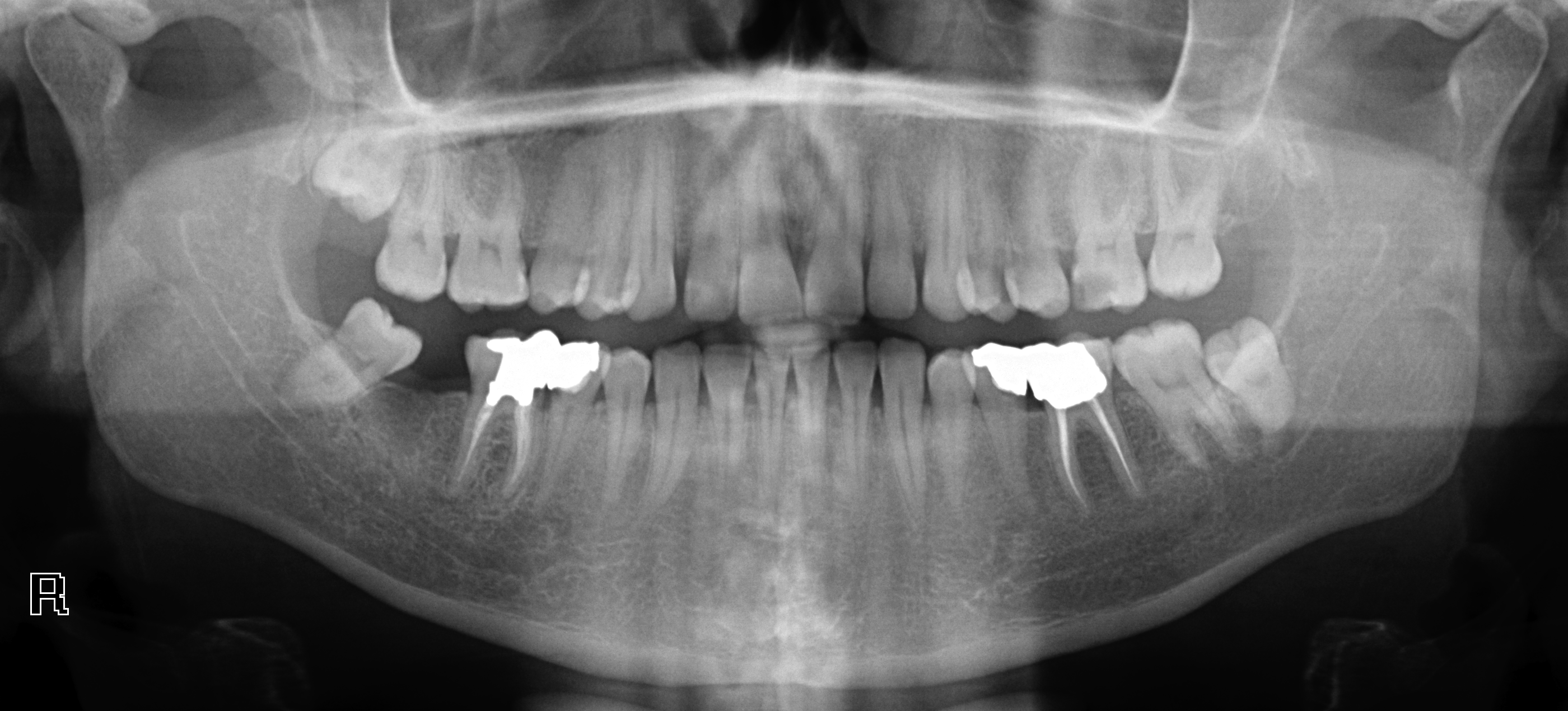 Cavitydetection Object Detection Dataset By Cavity Detection