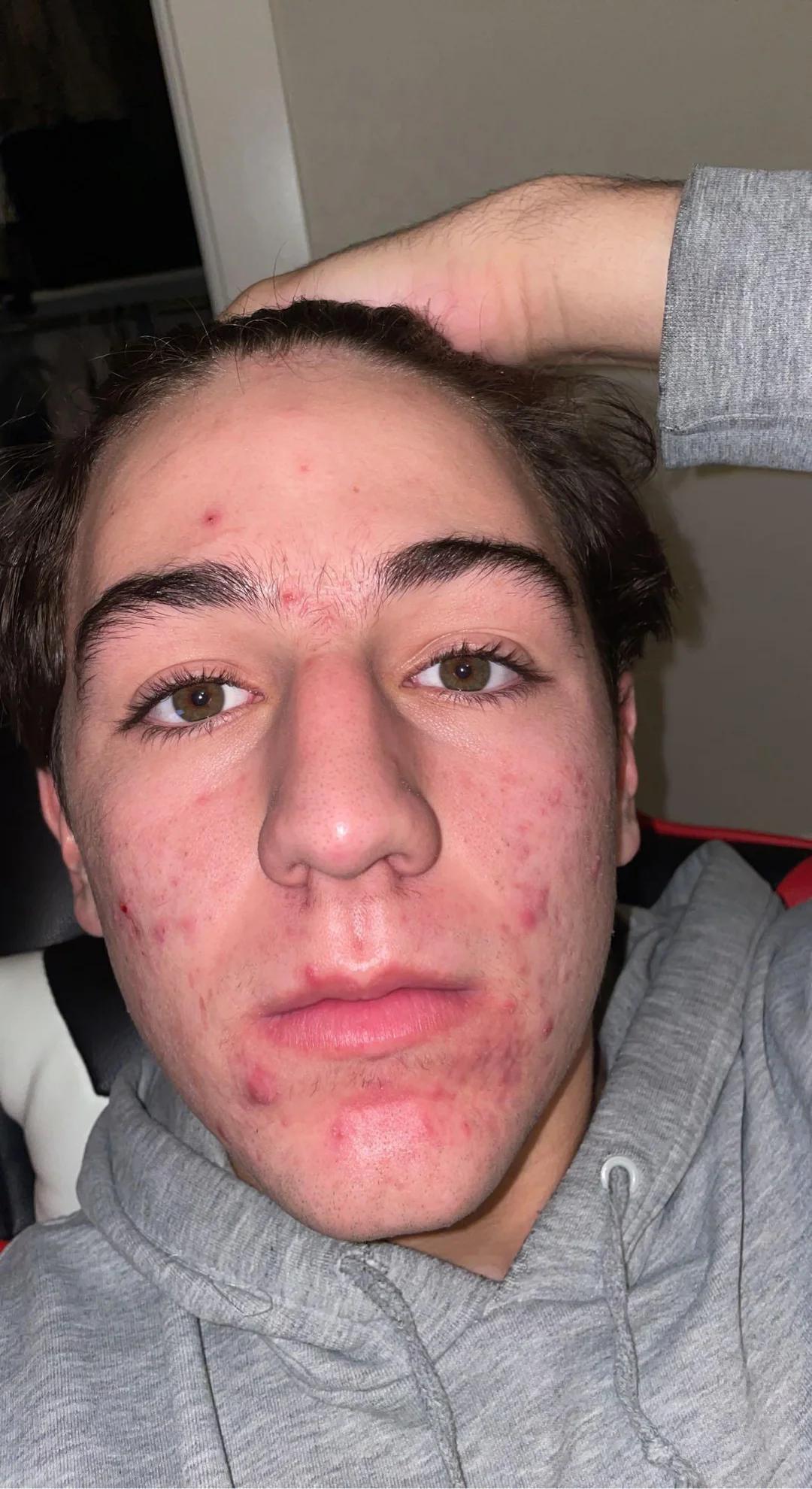 skin2 Instance Segmentation Dataset and Pre-Trained Model by skin