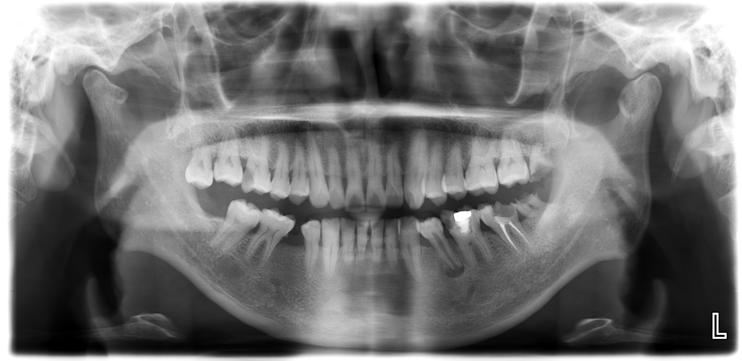 Dental Caries Detection using DL Object Detection Model by Project Group13