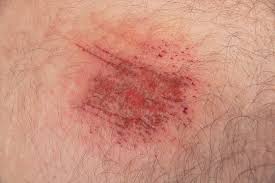 How to Use the Wound Assessment Instance Segmentation API