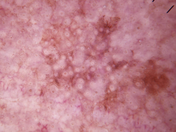 skin cancer Classification Dataset by skin cancer