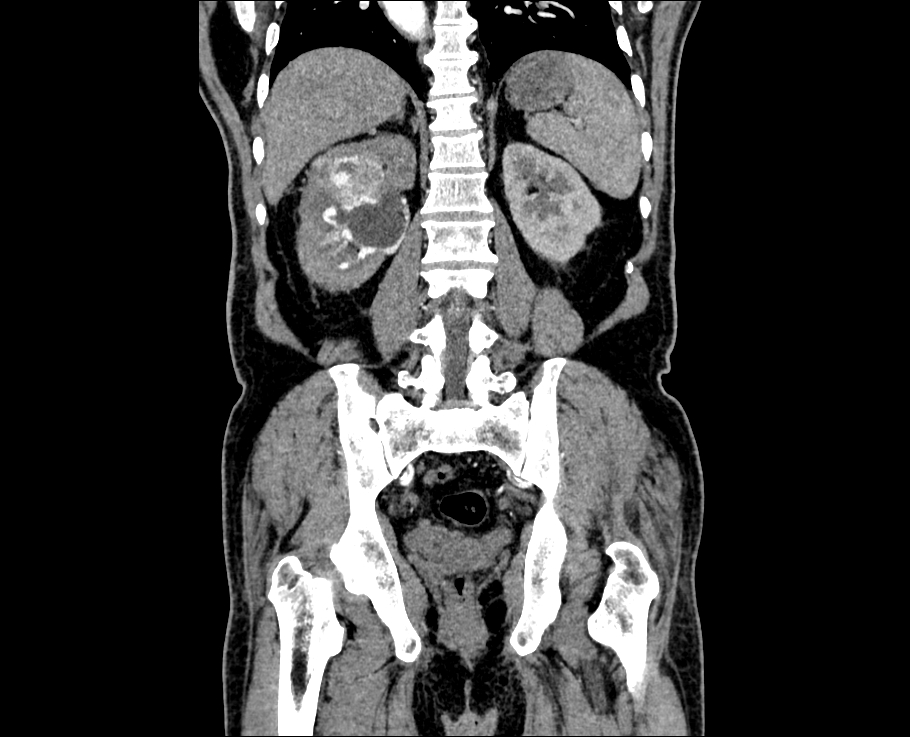 Kidney_Tumor Object Detection Model by East Delta University