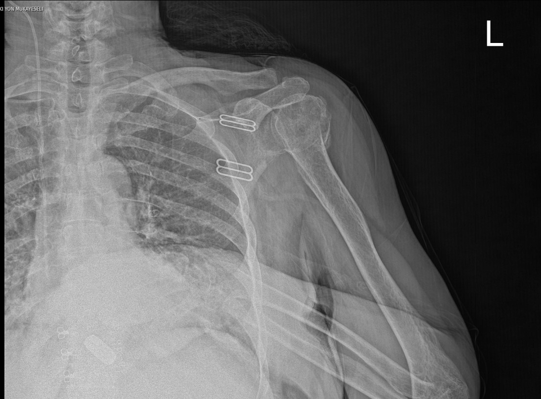 HUMERUS Instance Segmentation Dataset by sercan