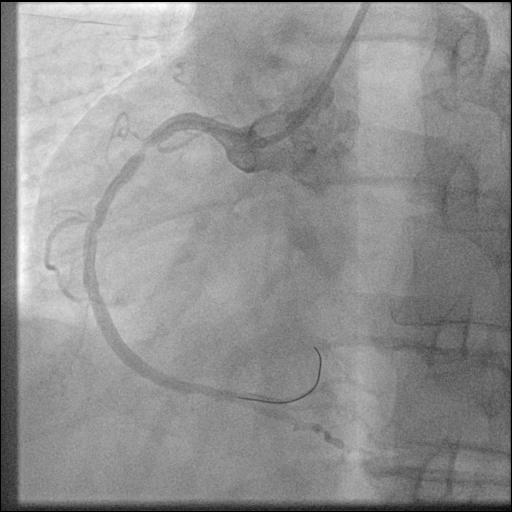 ARCADE-stenosis Instance Segmentation Dataset and Pre-Trained Model by project